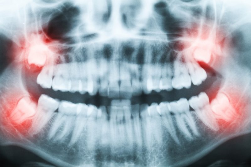 Emergency Wisdom Tooth Extraction in Fairfax, VA | Dentcare Now